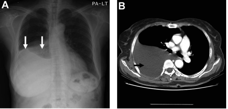 Ovarian Granulosa Cell Tumor presenting as Meigs' Syndrome with ...