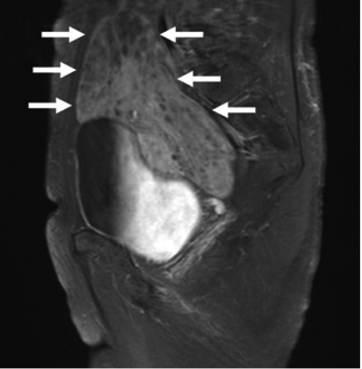 Ovarian Granulosa Cell Tumor presenting as Meigs' Syndrome with ...