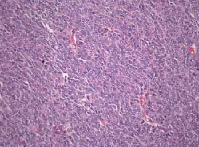 Ovarian Granulosa Cell Tumor presenting as Meigs' Syndrome with ...