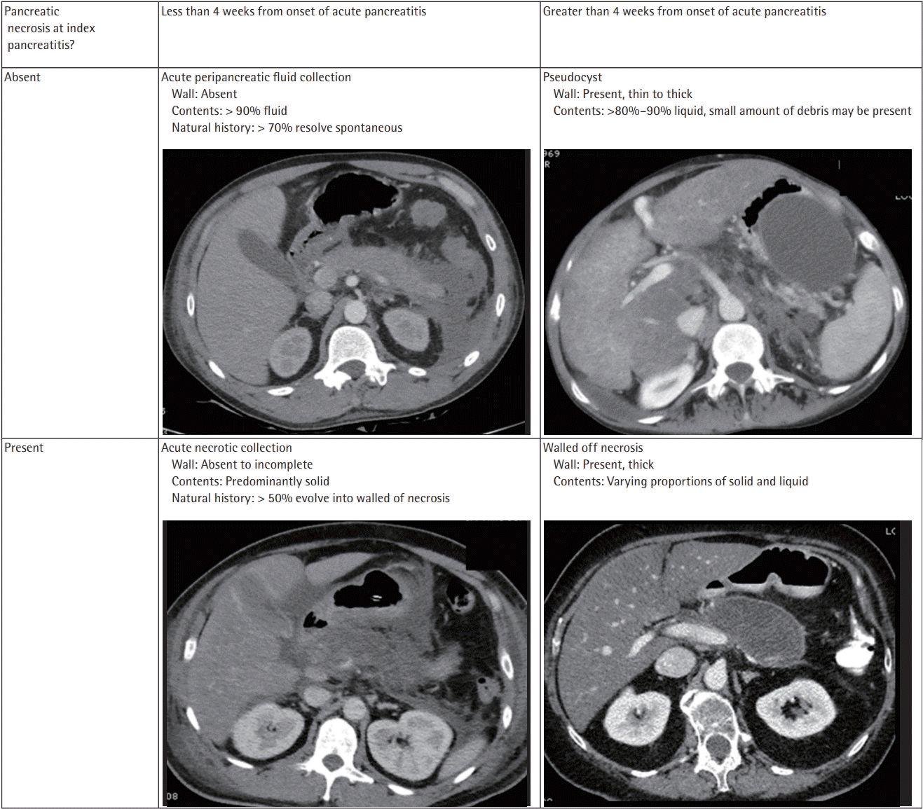 Walled Off Pancreatic Necrosis